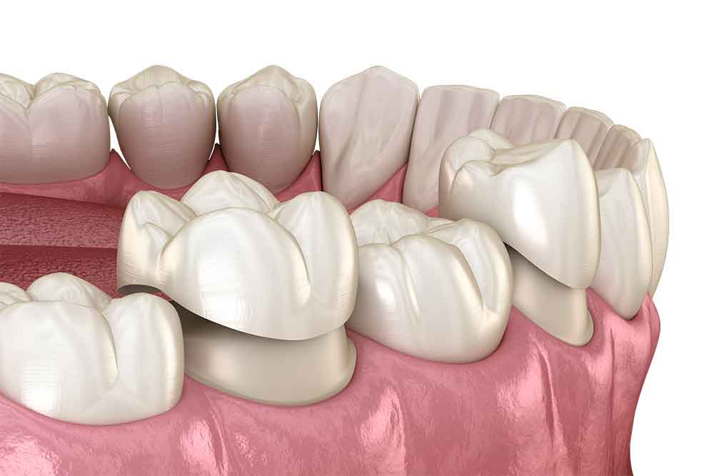 Dental Crowns in Ridgeland, MS | Joe Burns, DDS Family & Cosmetic Dentistry